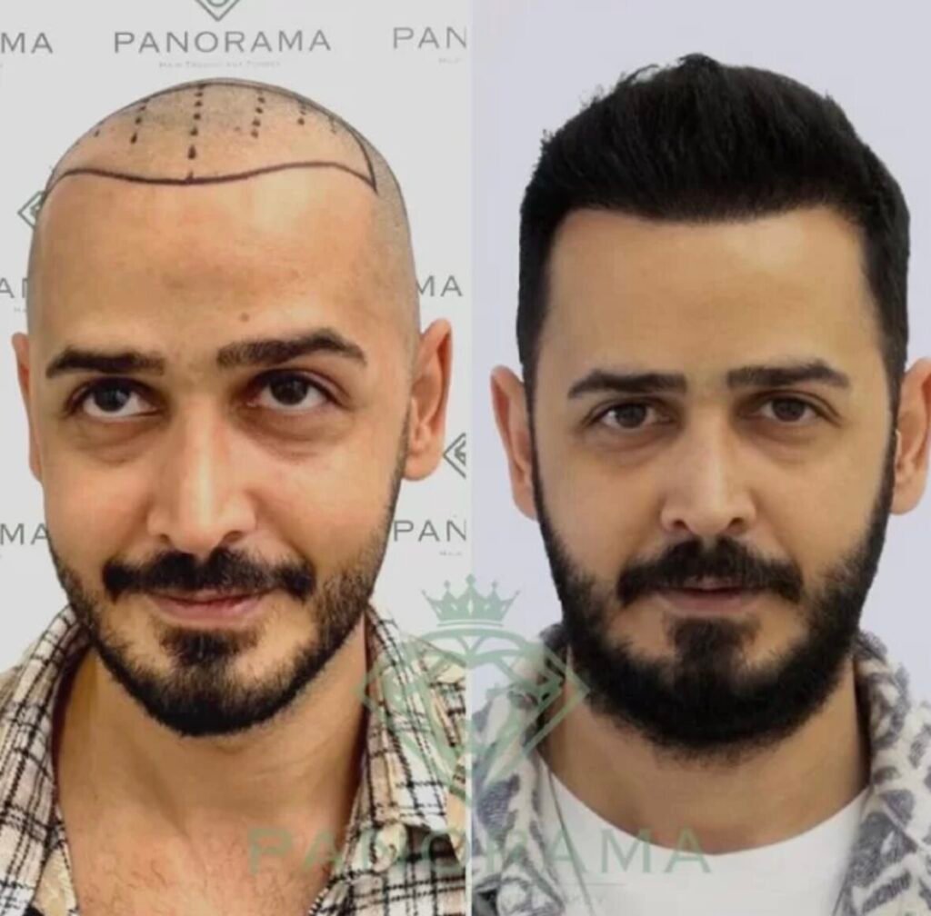 Natural and Permanent Hair Transplant in Turkey with Panorama Hair ...